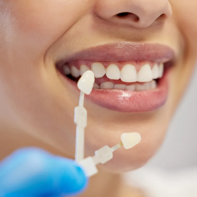 Veneers in Istanbul: What You Need to Know Before You Get Started